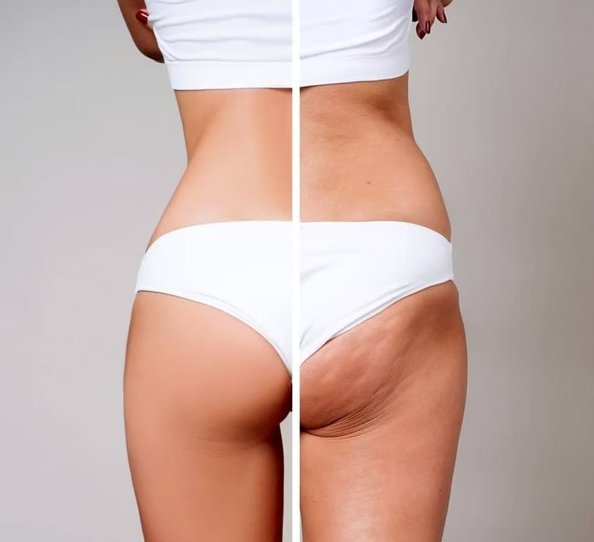 Sculptra Butt Lift: £600