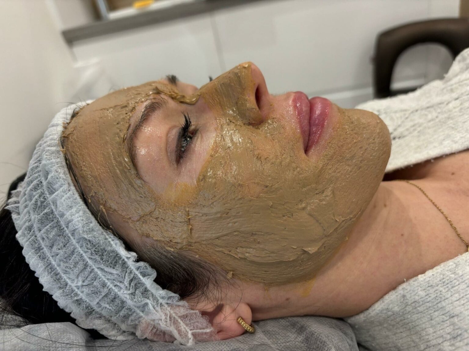 Cosmelan Melasma peel - Skinoza Clinic