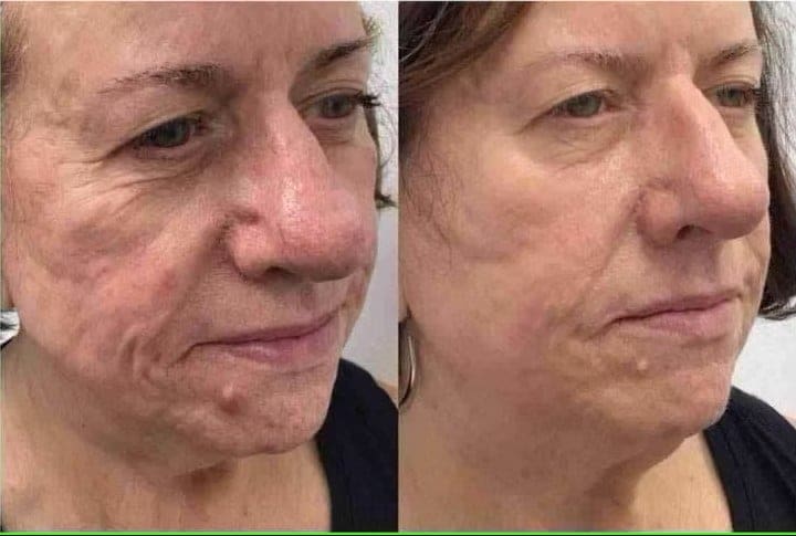 Radiofrequency Microneedling for Glowing Firm Skin From £150