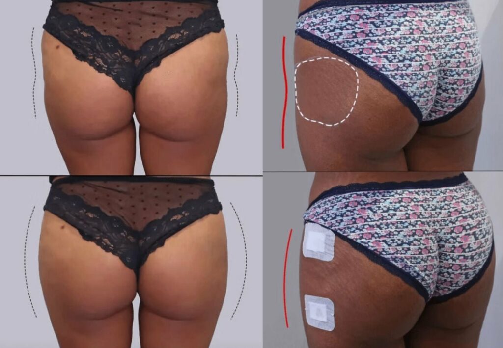 Sculptra Butt Lift: £600