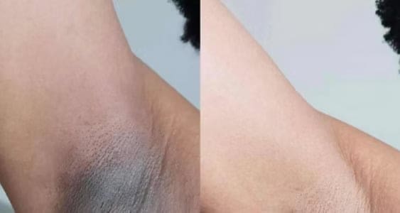 Dermamelan Intimate Peel: from £283