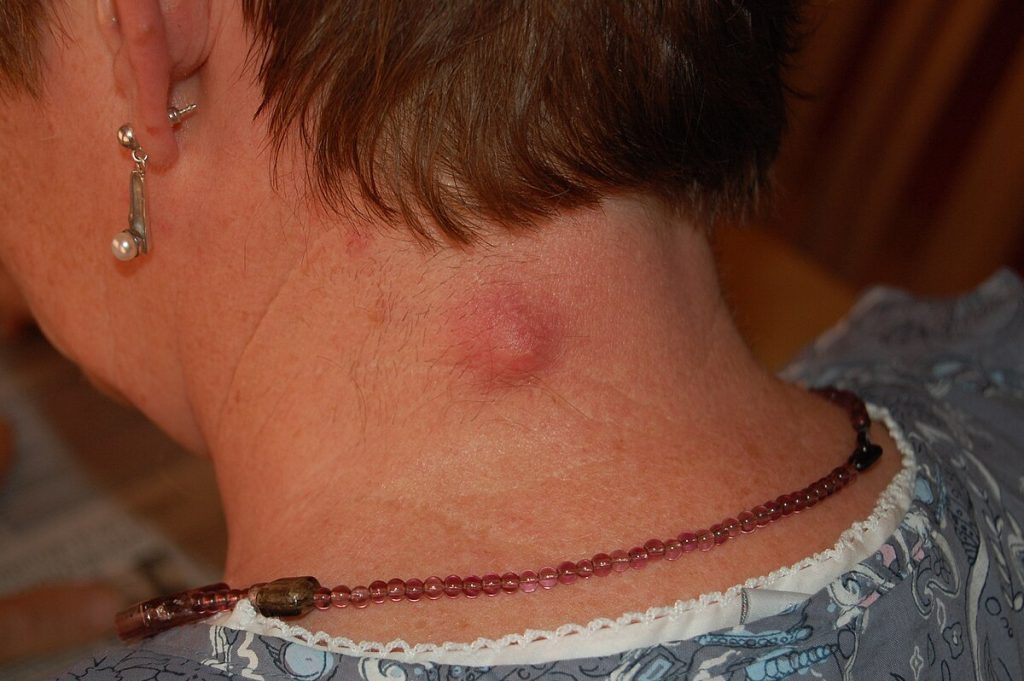 Lump and Cyst Removal: Safe, Professional, Effective Care