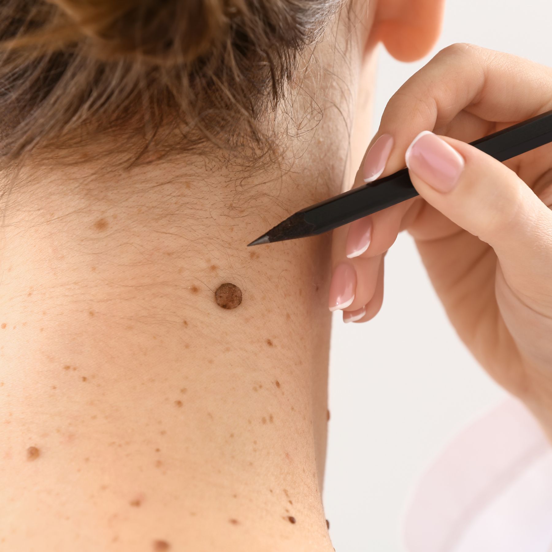 Mole Removal: Safe, Precise, Expert Care